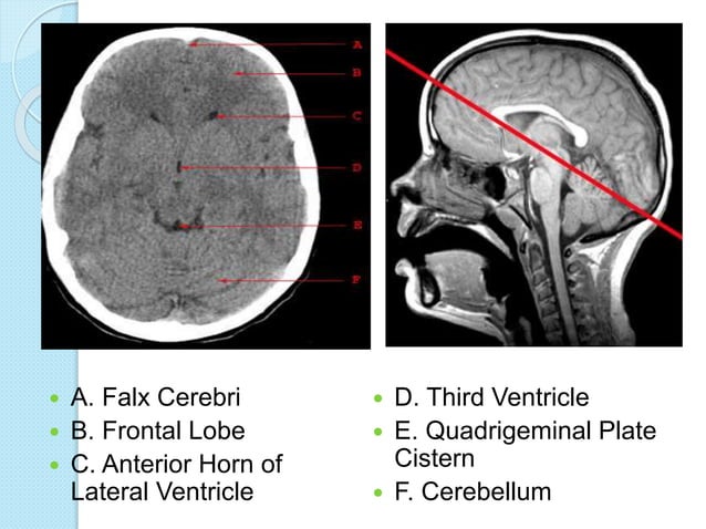 Normal Brain CT Scan Vs Hydrocephalus explained | PPTX | Brain and ...