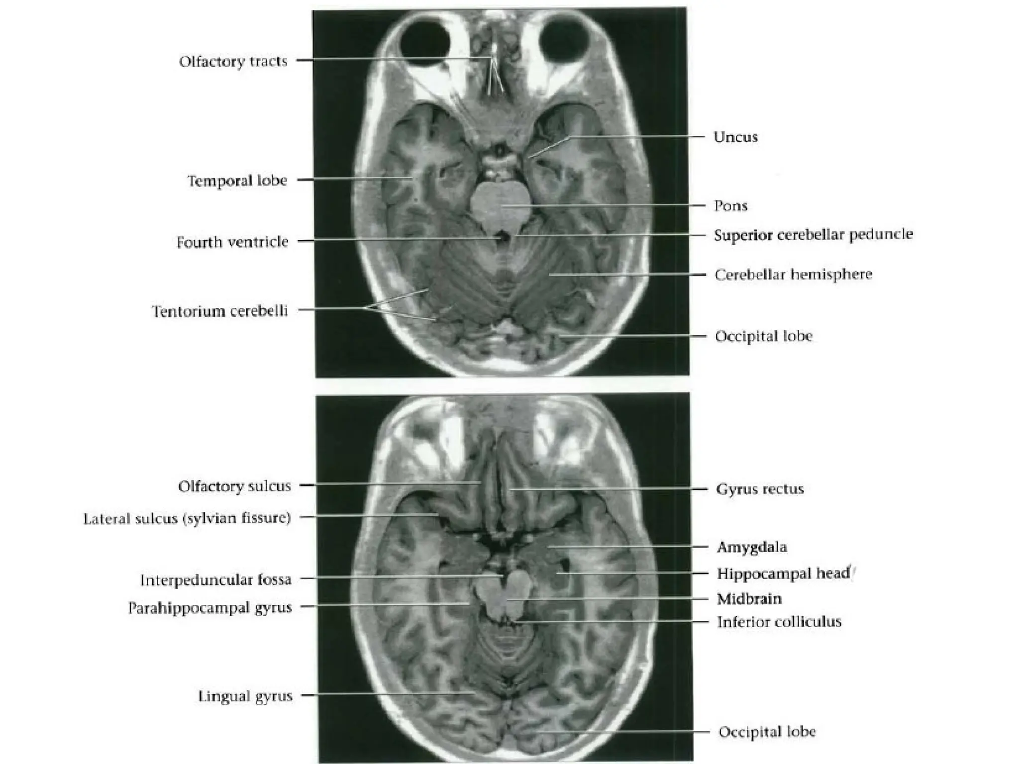 Normal brain & vascualar anatomy human body radiology imaging.pptx