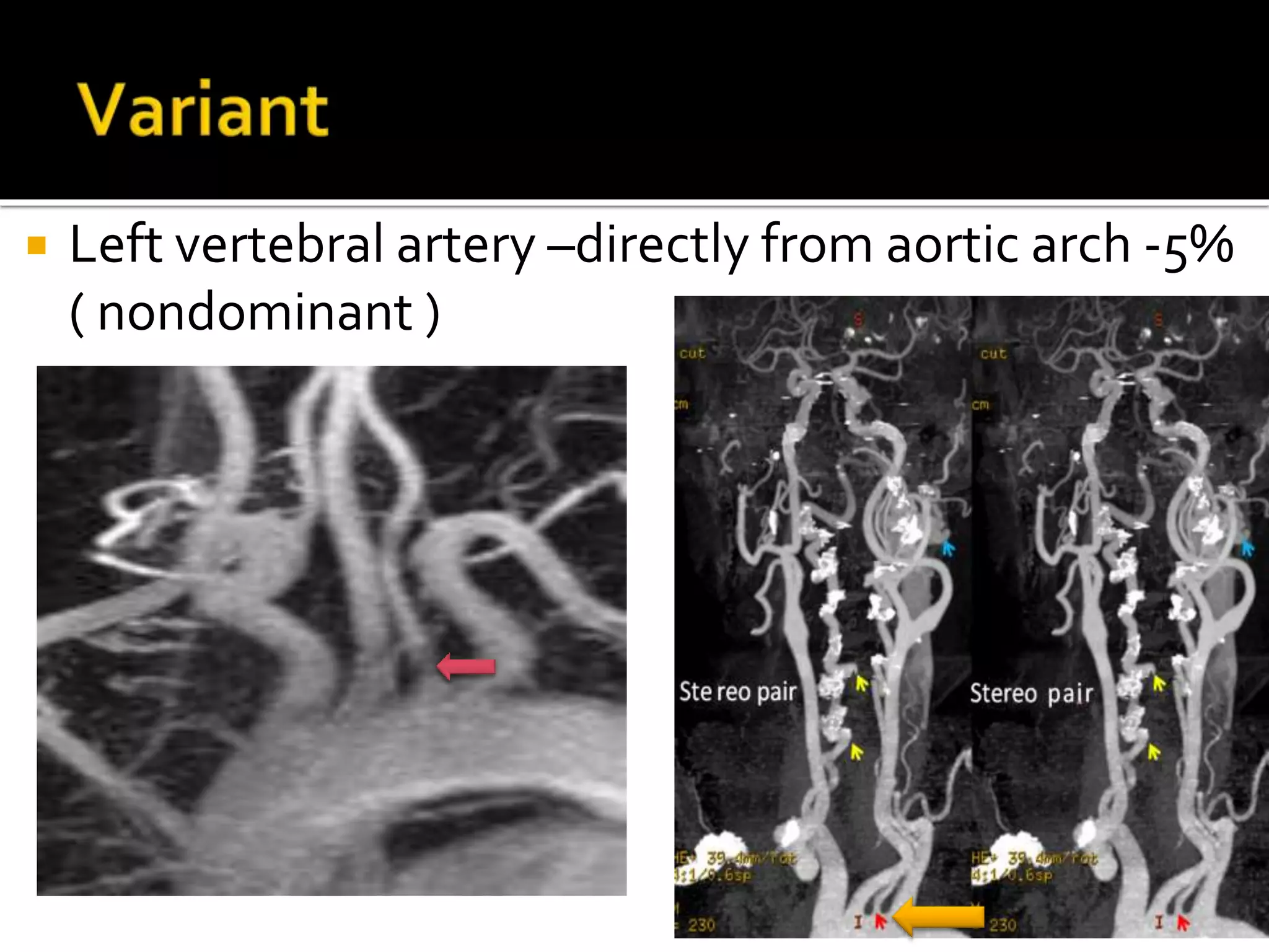 Normal cerebral angiogram final | PPTX