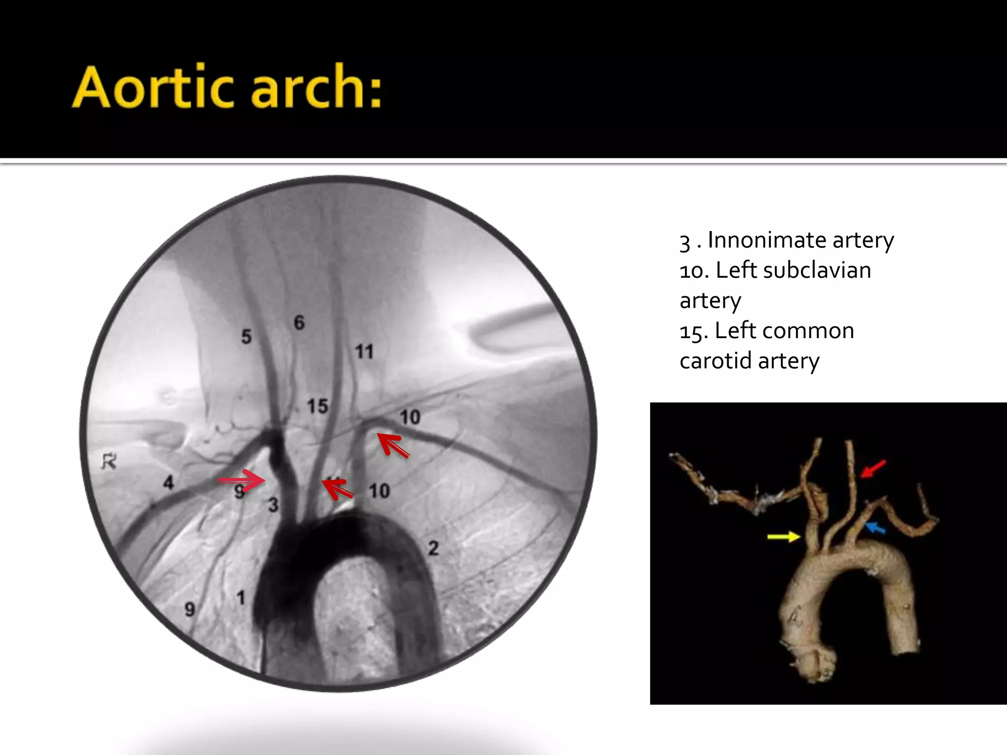 Normal cerebral angiogram final | PPTX