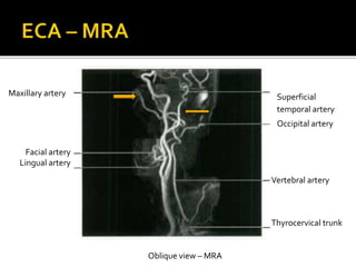 Normal cerebral angiogram final | PPTX