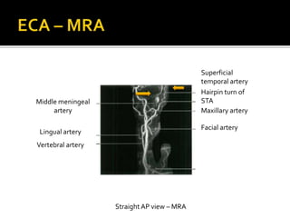 Normal cerebral angiogram final | PPTX