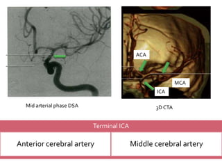 Normal cerebral angiogram final | PPTX