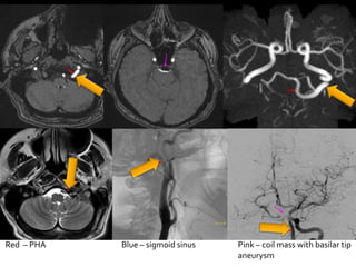 Normal cerebral angiogram final | PPTX