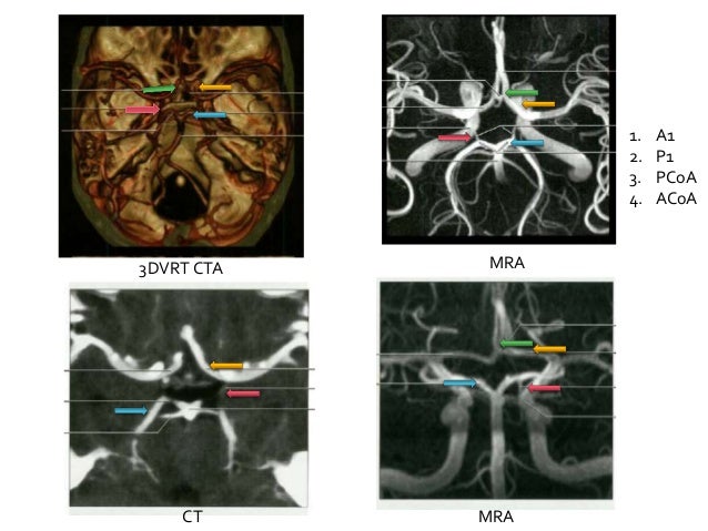 Normal cerebral angiogram final