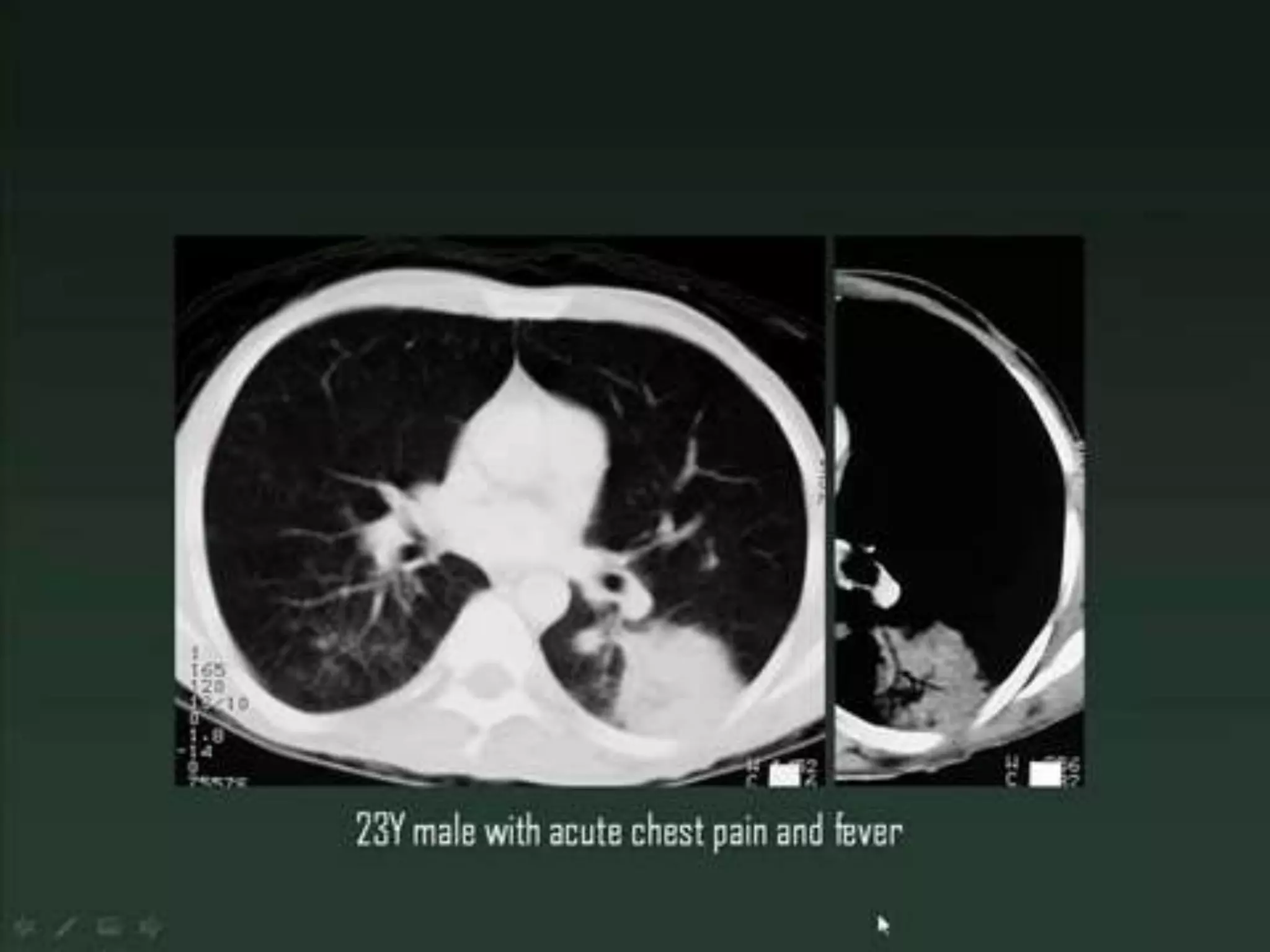 Normal chest ct | PPSX