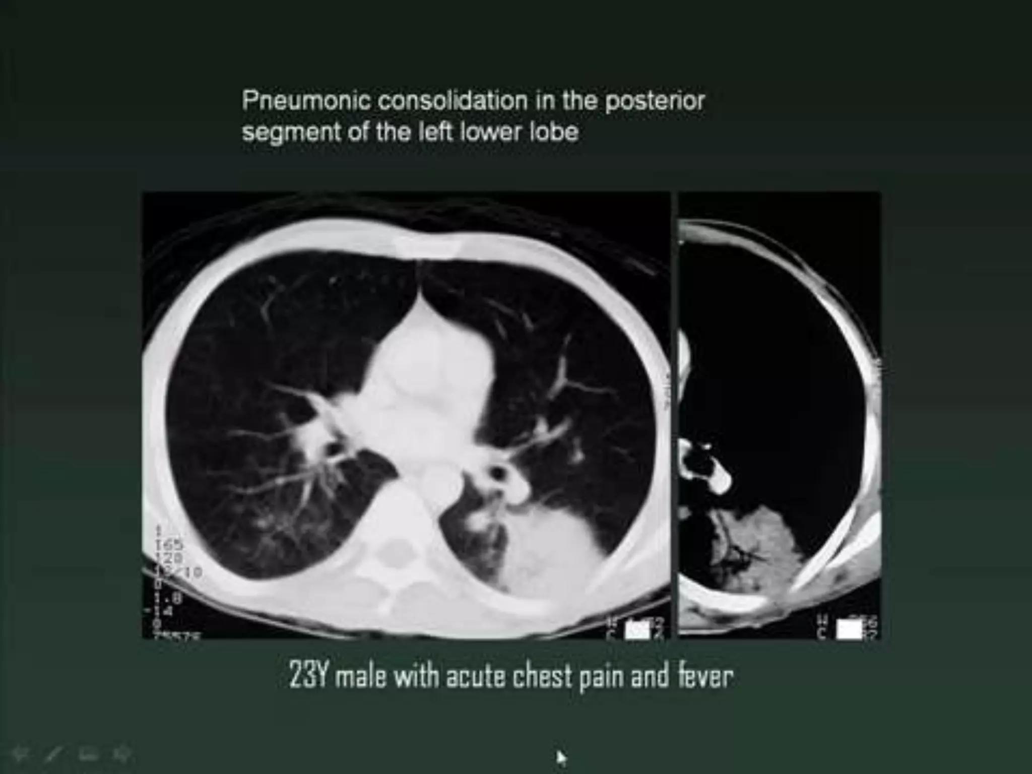 Normal chest ct | PPSX