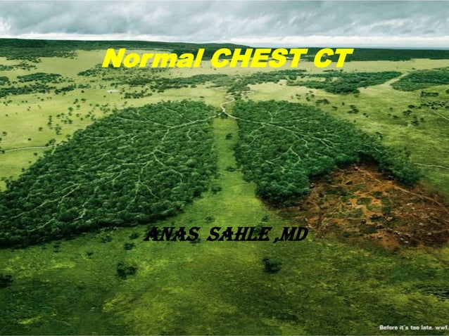 Normal chest ct | PPSX
