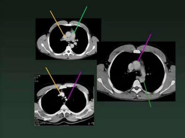 Normal chest ct | PPSX