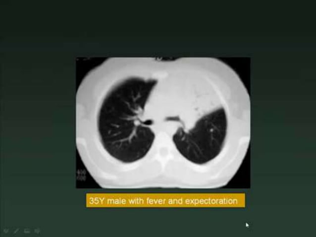 Normal chest ct | PPSX