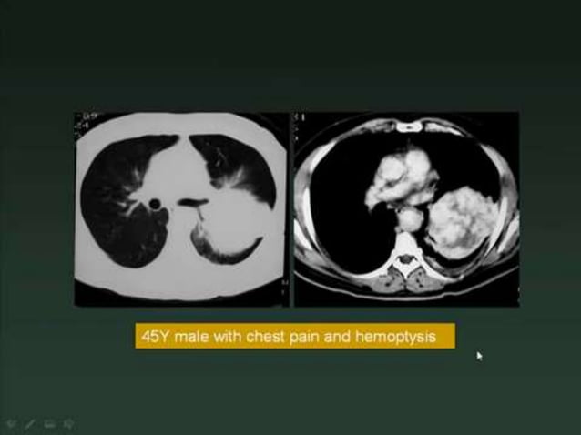 Normal chest ct | PPSX