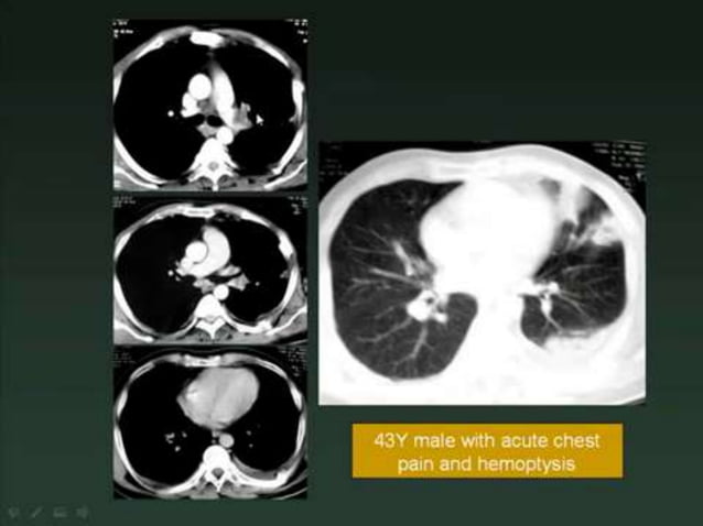 Normal chest ct | PPSX