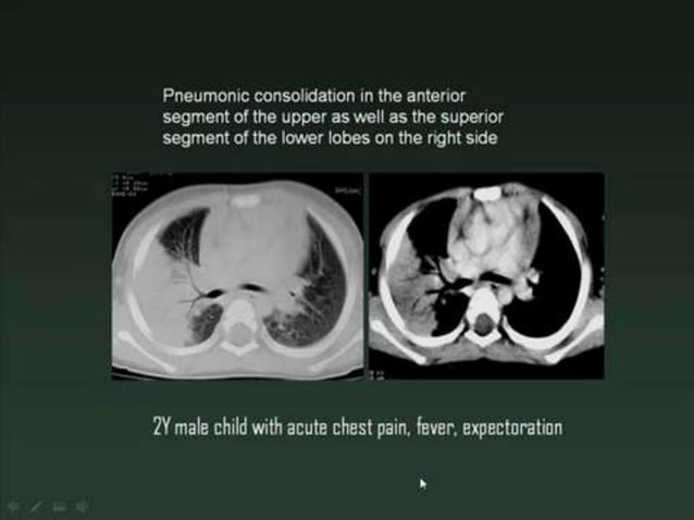 Normal chest ct | PPSX | Lung and Respiratory Health | Diseases and ...
