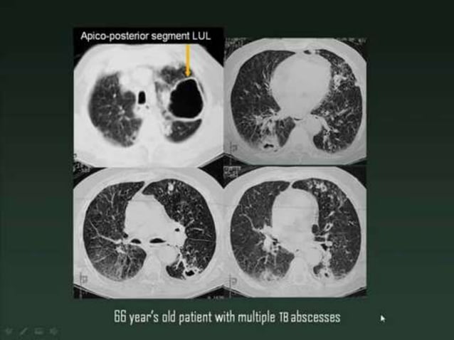 Normal chest ct | PPSX | Lung and Respiratory Health | Diseases and ...