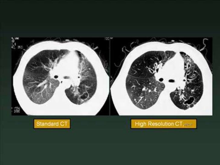 Normal chest ct