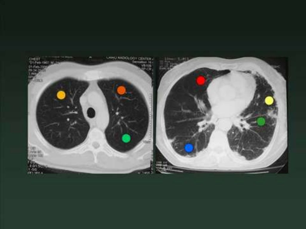 Normal chest ct