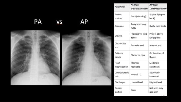 NORMAL CHEST RADIOGRAPGH AND ANATOMY.pptx.pptx