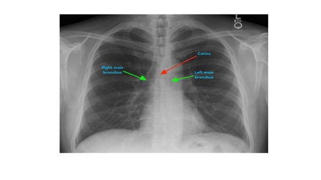 NORMAL CHEST RADIOGRAPH 23-0 7-2019.pptx
