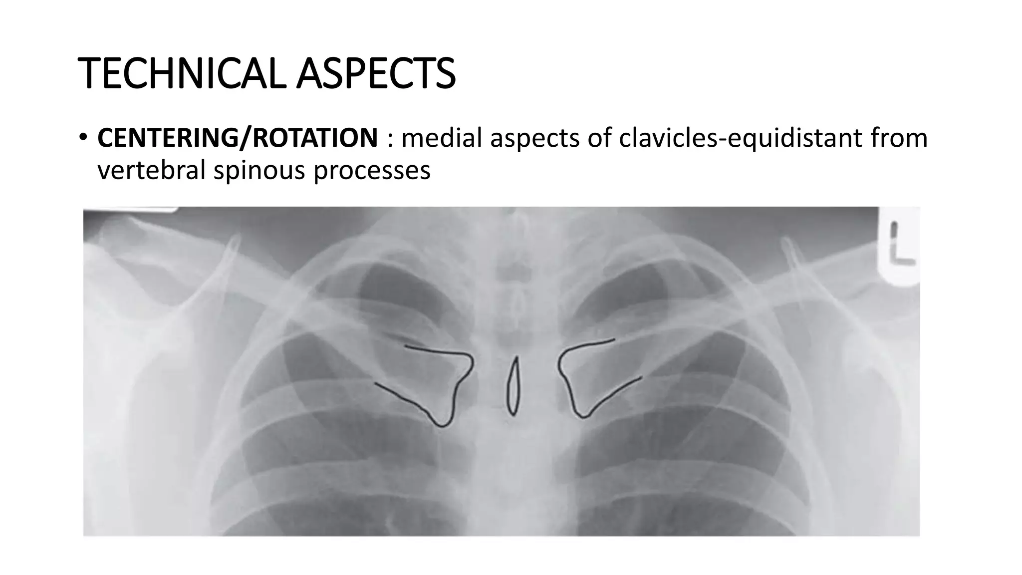 Normal chest x ray- Radiology Basics | PPTX