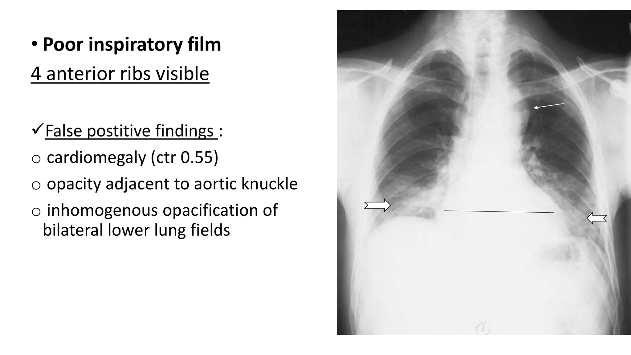 Normal chest x ray- Radiology Basics | PPTX