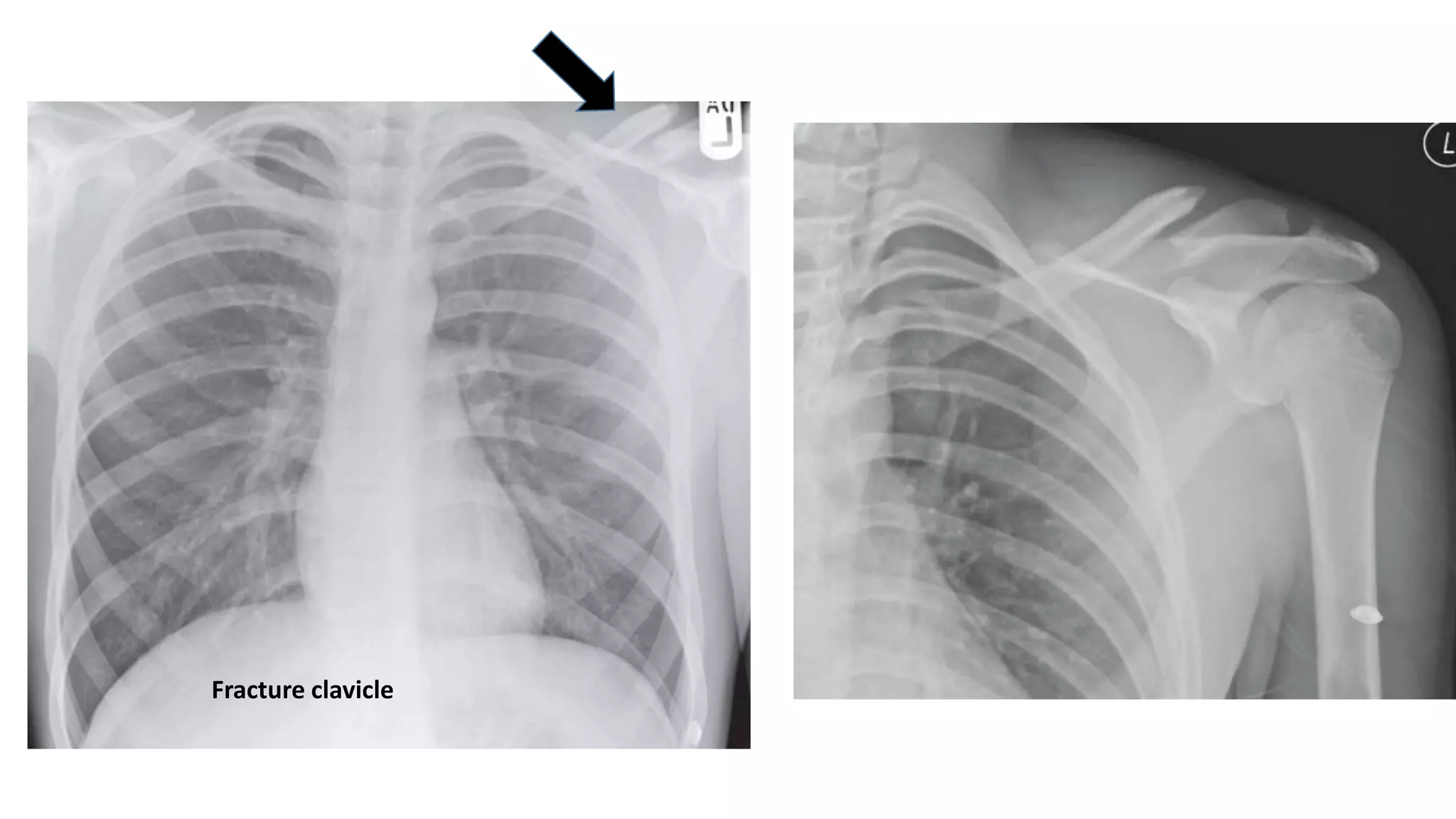 Normal chest x ray- Radiology Basics | PPTX