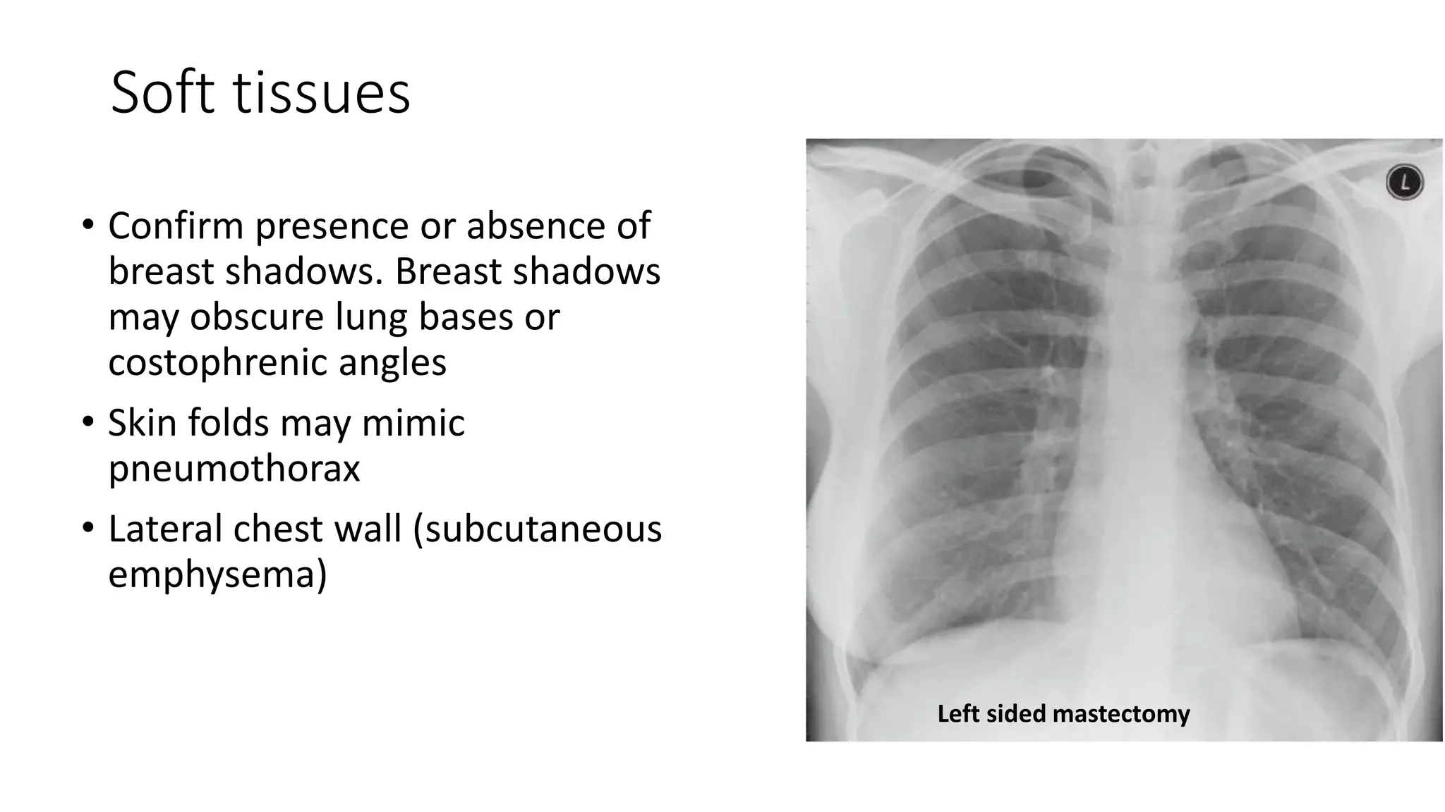 Normal chest x ray- Radiology Basics | PPTX | Lung and Respiratory ...