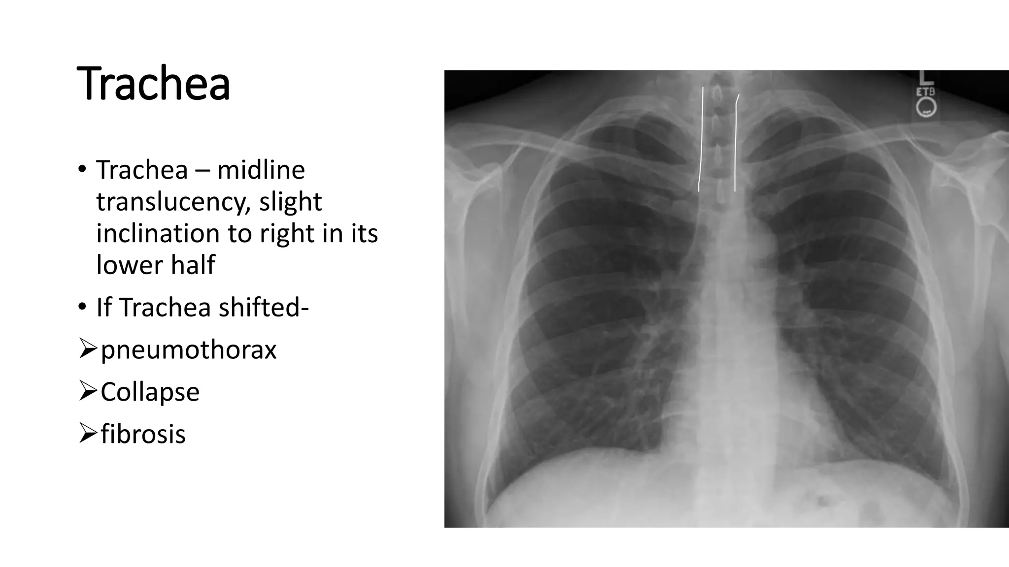 Normal chest x ray- Radiology Basics | PPTX | Lung and Respiratory ...