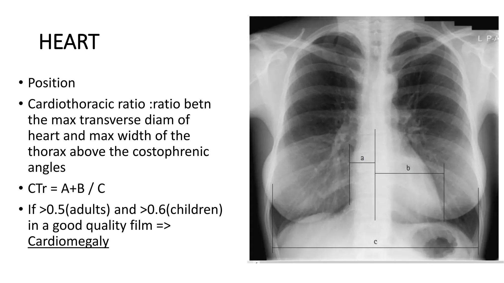 Normal chest x ray- Radiology Basics | PPTX