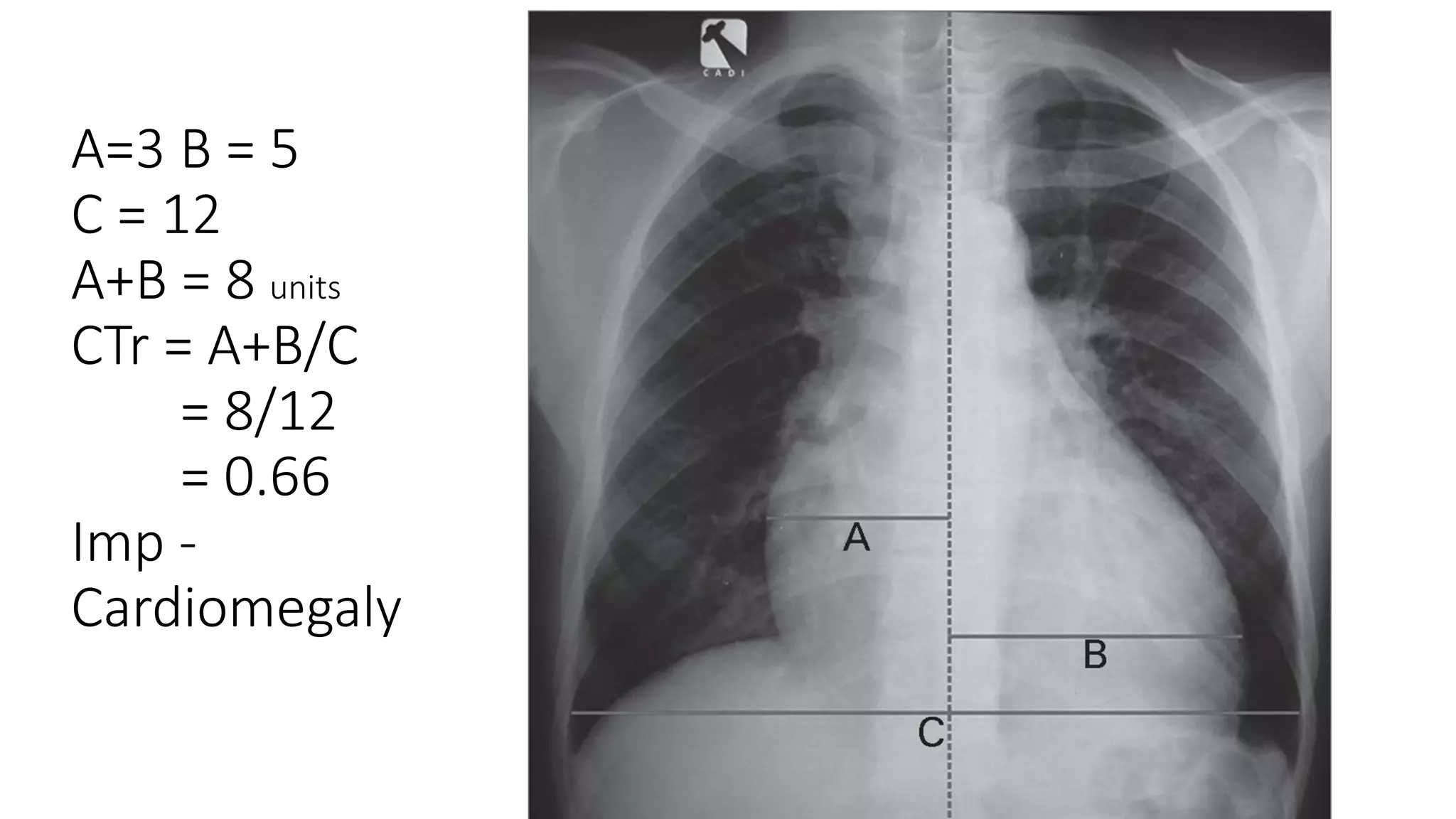 Normal chest x ray- Radiology Basics | PPTX