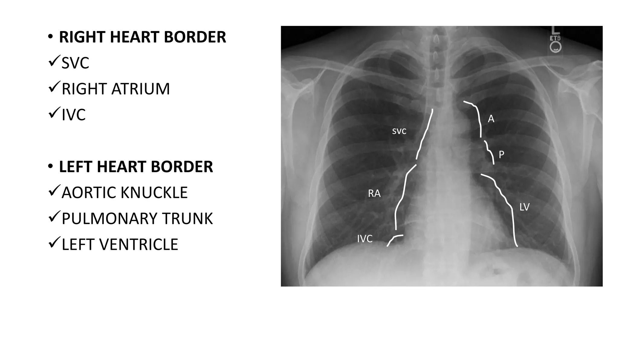 Normal chest x ray- Radiology Basics | PPTX