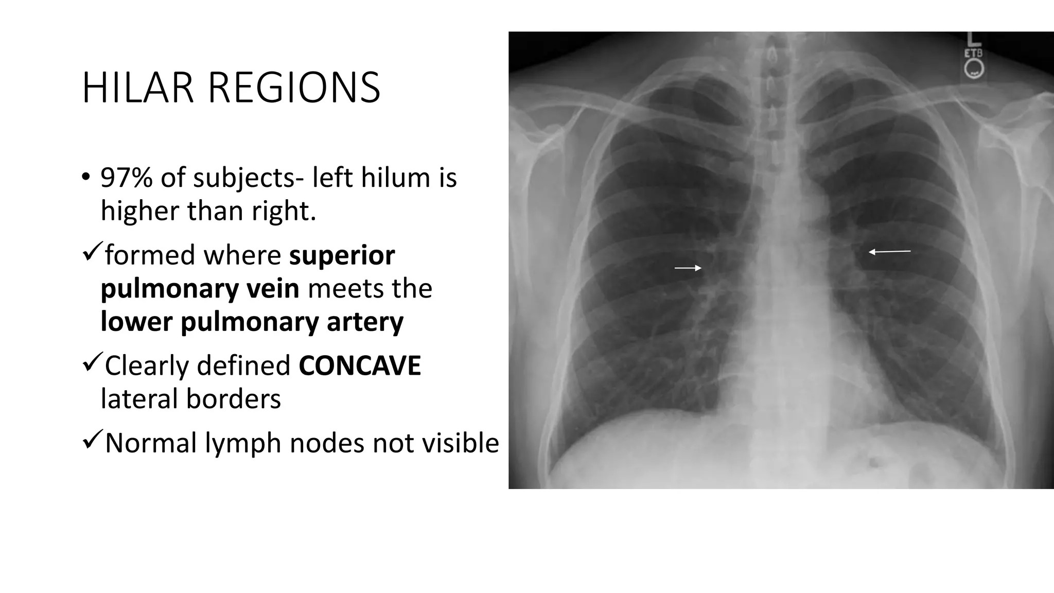 Normal chest x ray- Radiology Basics | PPTX | Lung and Respiratory ...