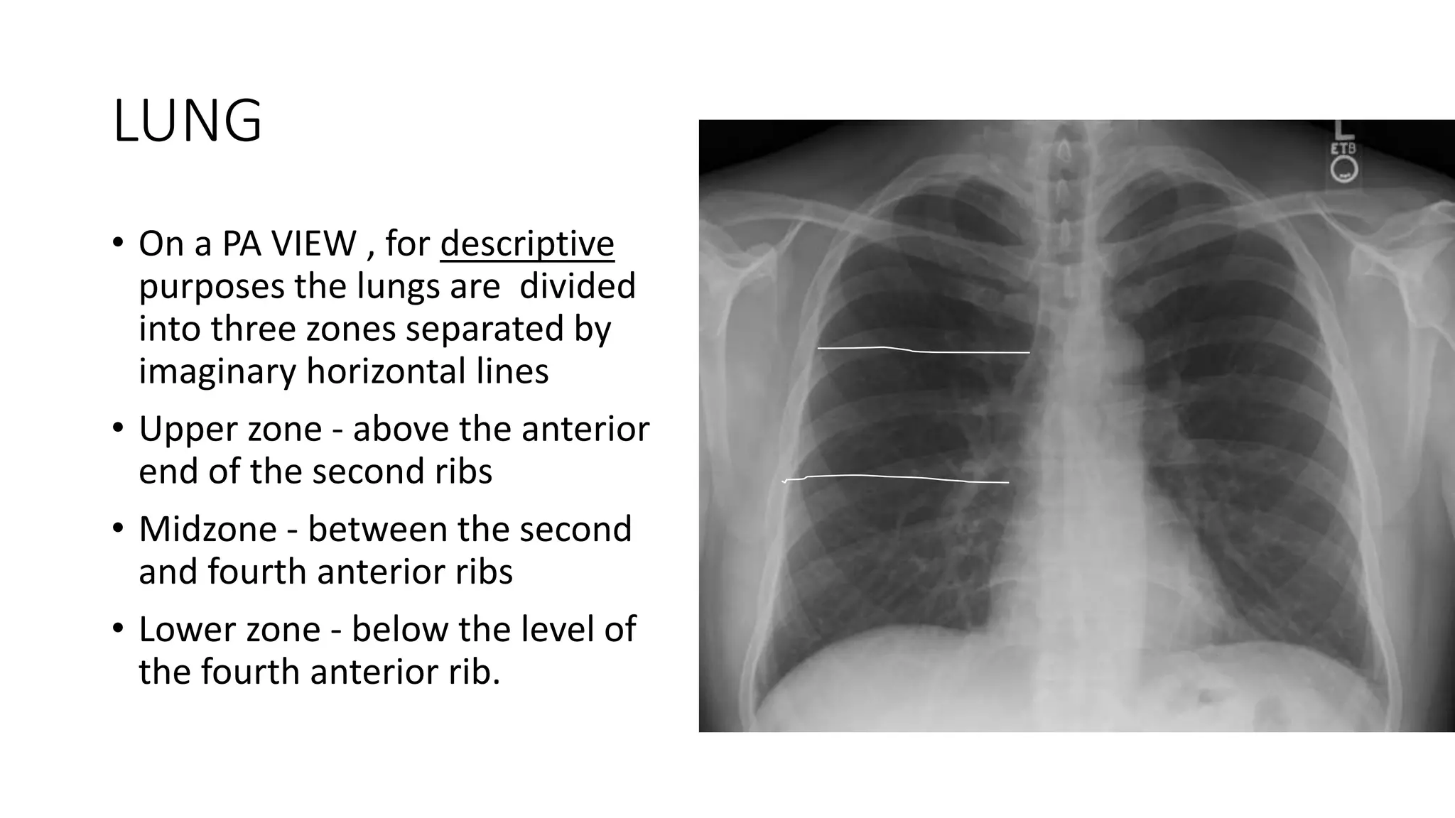 Normal chest x ray- Radiology Basics | PPTX