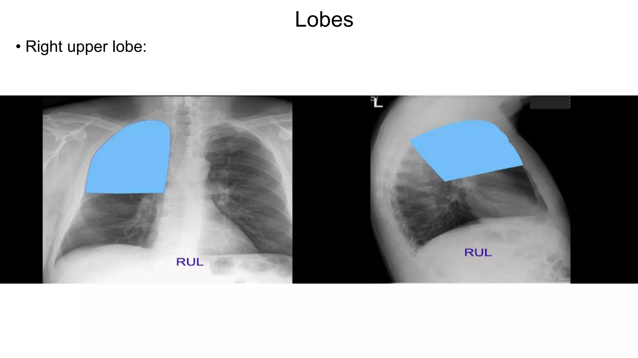 Normal chest x ray- Radiology Basics | PPTX