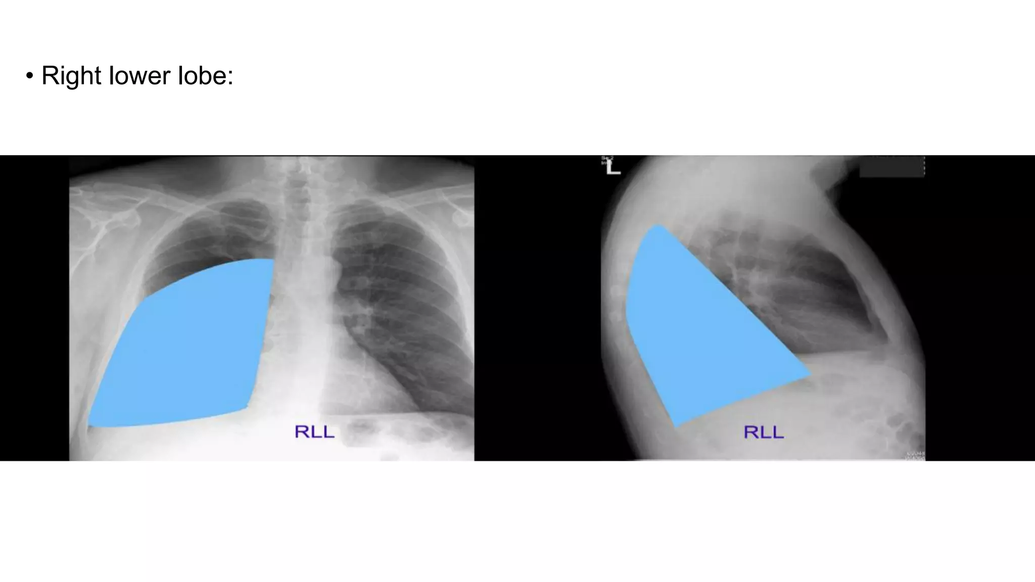 Normal chest x ray- Radiology Basics | PPTX | Lung and Respiratory ...