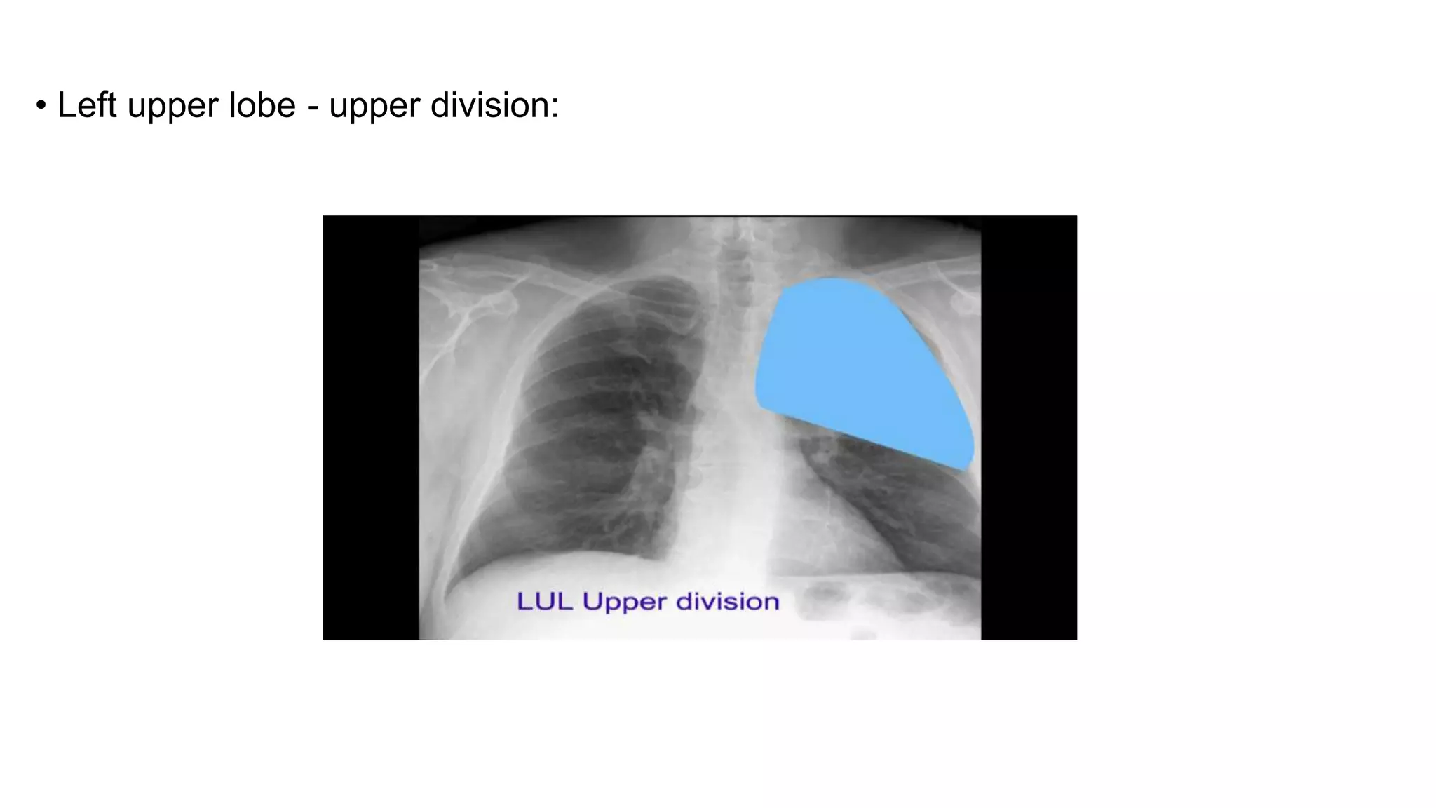 Normal chest x ray- Radiology Basics | PPTX