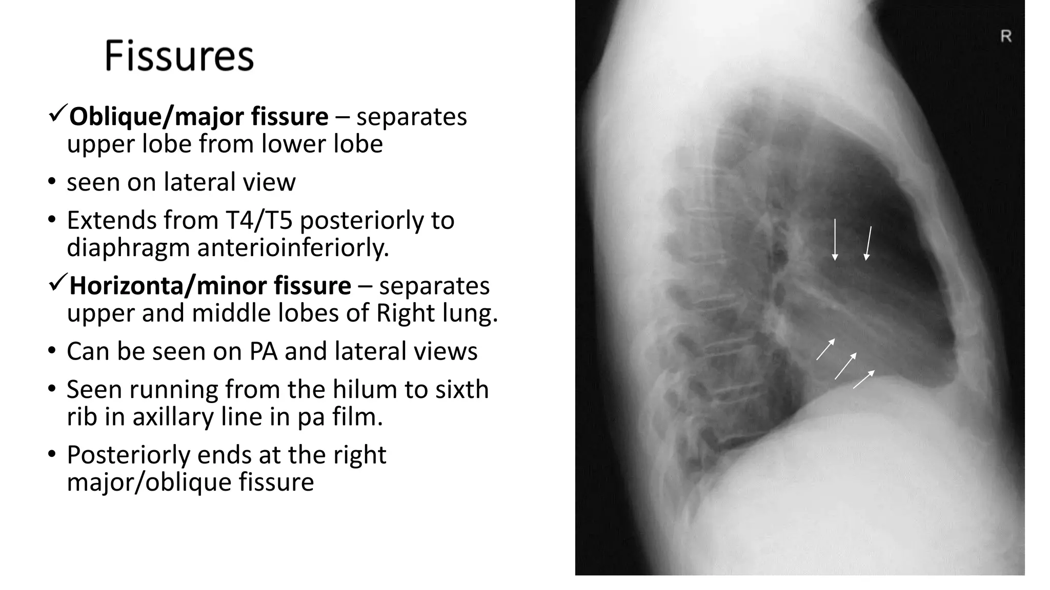 Normal chest x ray- Radiology Basics | PPTX