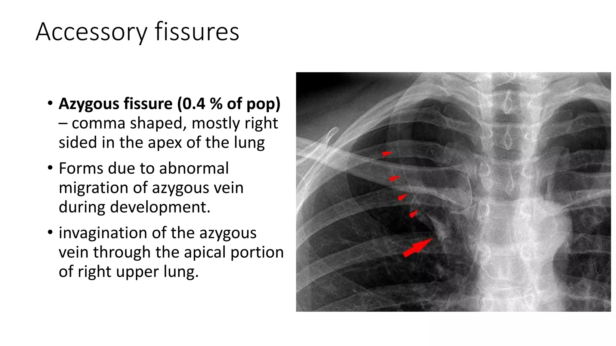 Normal chest x ray- Radiology Basics | PPTX | Lung and Respiratory ...