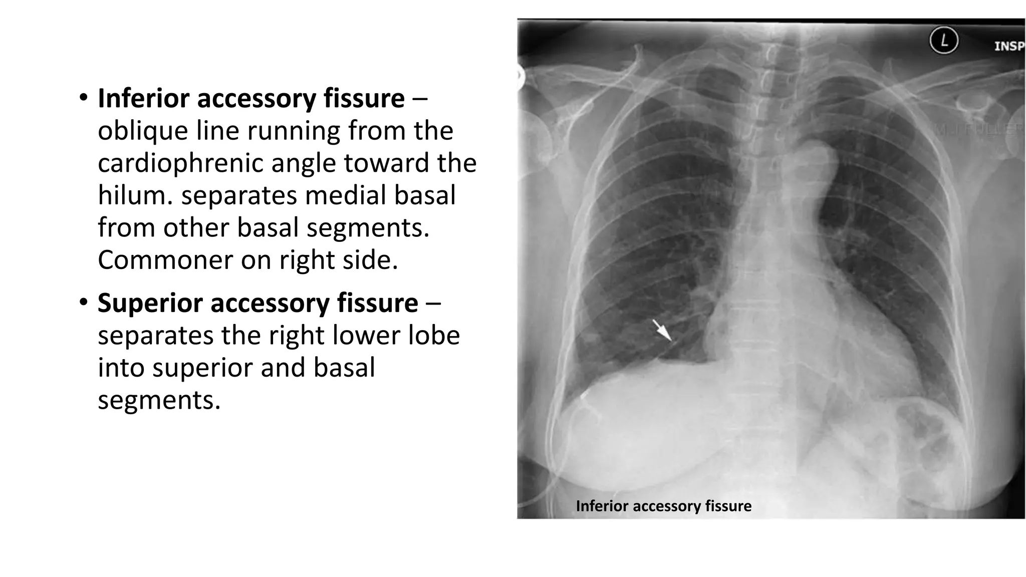 Normal chest x ray- Radiology Basics | PPTX