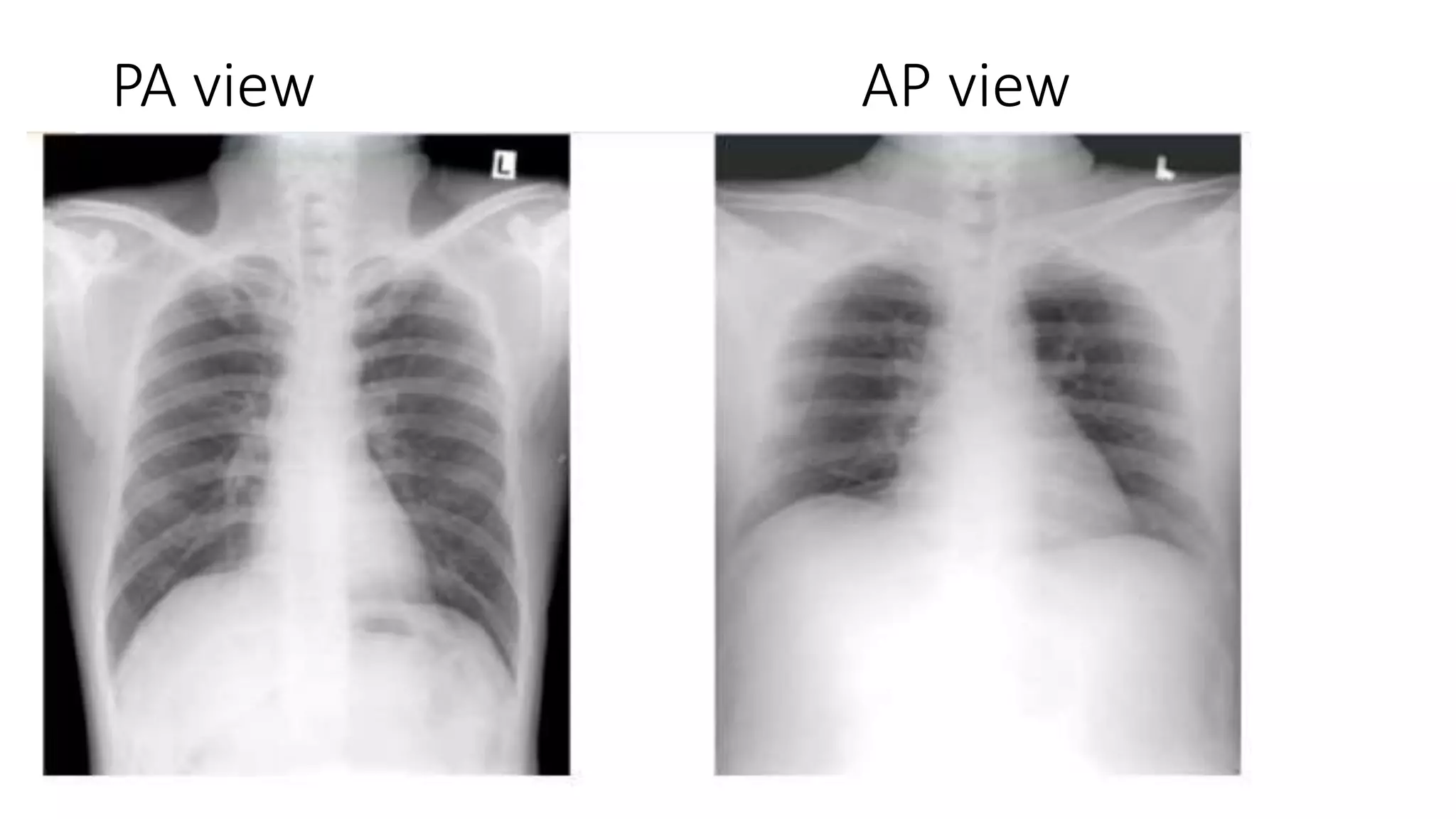 Normal chest x ray- Radiology Basics | PPTX