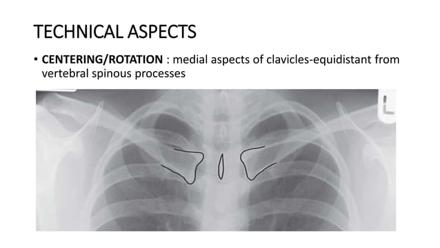 Normal chest x ray- Radiology Basics | PPTX | Lung and Respiratory ...