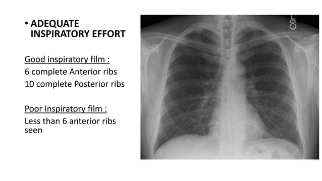 Normal chest x ray- Radiology Basics | PPTX | Lung and Respiratory ...