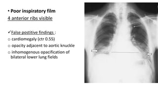 Normal chest x ray- Radiology Basics | PPTX