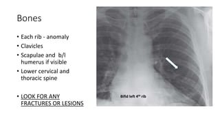 Normal chest x ray- Radiology Basics | PPTX