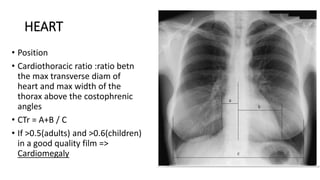 Normal chest x ray- Radiology Basics | PPTX