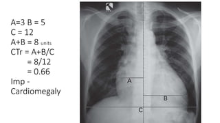 Normal chest x ray- Radiology Basics | PPTX