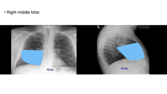 Normal chest x ray- Radiology Basics | PPTX | Lung and Respiratory ...