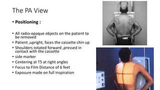 Normal chest x ray- Radiology Basics | PPTX