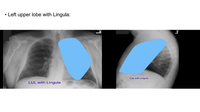 Normal chest x ray- Radiology Basics | PPTX | Lung and Respiratory ...