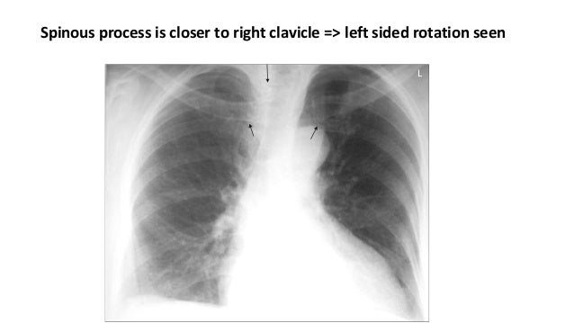 Normal chest x ray- Radiology Basics