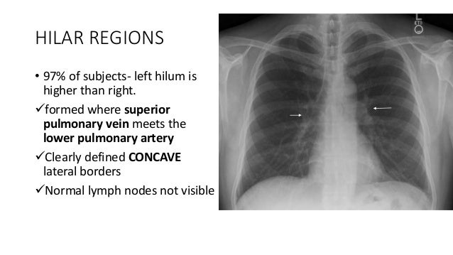 Normal chest x ray- Radiology Basics